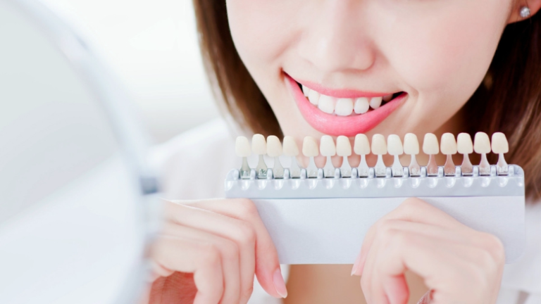 Veneer Gigi: Prosedur, Manfaat, dan Biayanya yang Perlu Anda Tahu - InfoKerenMu